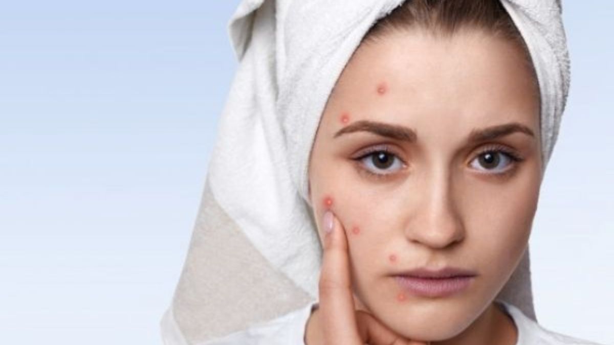 ಟೆನ್ಷನ್‌ ಬಿಡಿ: ಮೊಡವೆ ನಿವಾರಣೆಗೆ ಇಲ್ಲಿದೆ ಸುಲಭದ 5 ಮನೆ ಮದ್ದು! | Five Simple ...